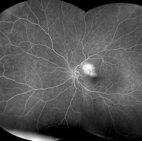 Advanced Retinal Imaging Technology For Early Detection Of Retinal Disease