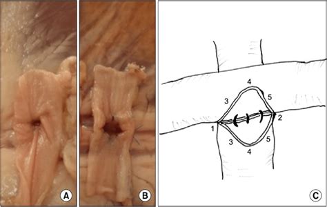 Sequential Anastomosis Using A Continuous And B Interrupted