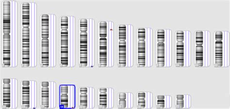 Chromosome Microarray Analysis Results Of All Chromosomes Download