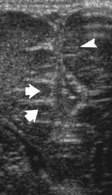 High Frequency Linear Array Transducer At Kenneth Keene Blog