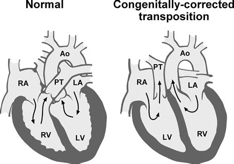 Corience Kongenital Korrigierte Transposition Pzgi