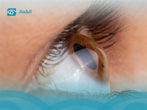 Get The Best Keratoconus Treatment