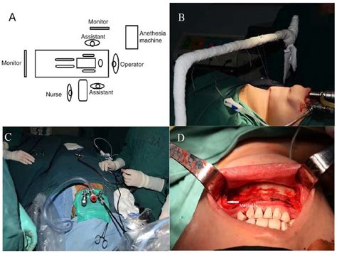 Procedures Of The Complete Endoscopic Radical Surgery Of Thyroid Cancer