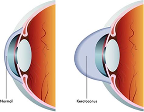 Keratoconus Eye Disorder Causes Symptoms Risk And Keratoconus
