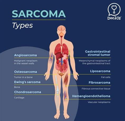 Understanding Sarcoma A Form Of Bone Cancer Fmt