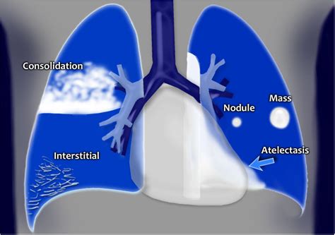 Chest X Ray Lung Disease Four Pattern Approach Nclex Quiz