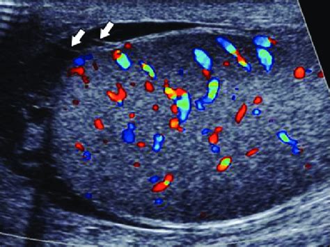 Pyocele Longitudinal Color Doppler Us Image In A 24 Year Old Man With Download Scientific