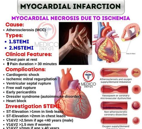 Myocardial Infarction Vital Signs Uxcl