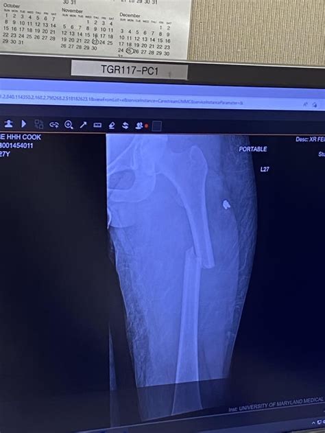 Complete Femur Fracture Before And After Orif R Radiology