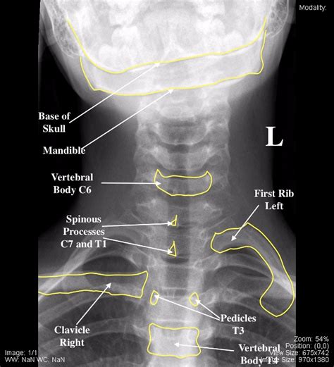 Cervical Spine Diagram X Ray