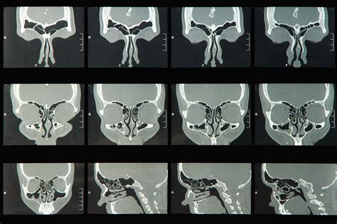 Nasal Polyps Surgery Before And After Nasal Polyps Tr