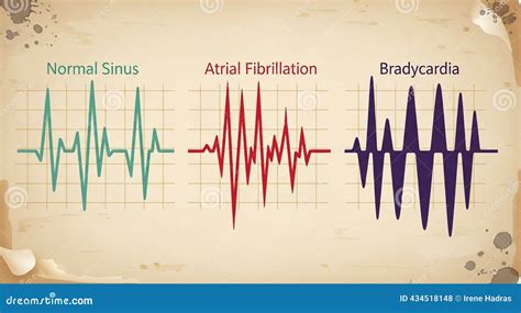 Three Medical Ecg Heart Rhythm Comparison Charts Showing Normal Sinus