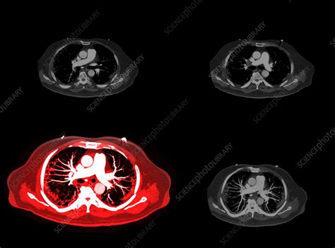 Pulmonary Artery Ct Scans Stock Image F037 7323 Science Photo Library