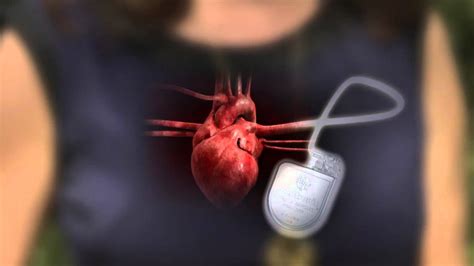 Icd Pacemaker Implantable Cardioverter Defibrillator Icd General Information Melbourne Heart