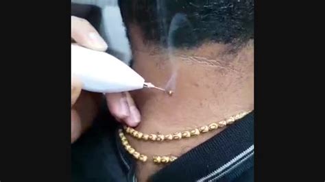 سرعت و دقت در آوردن خال بزرگ گوشتی با استفاده از دستگاه لیزر بیوتی پن