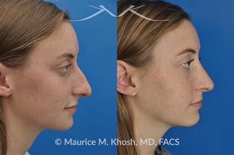 Hook Nose Before And After Before And After Photo Of A 24 Year Old
