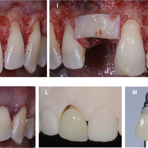 Case 2 H Restoration Of The Ideal Bone Contours After Ostectomy And Download Scientific