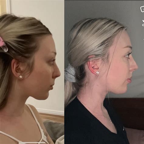 Sucking Method R Mewing