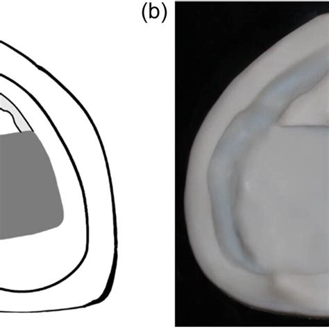 Pdf Classification Of Maxillectomy In Edentulous Arch Defects Algorithm Concept And