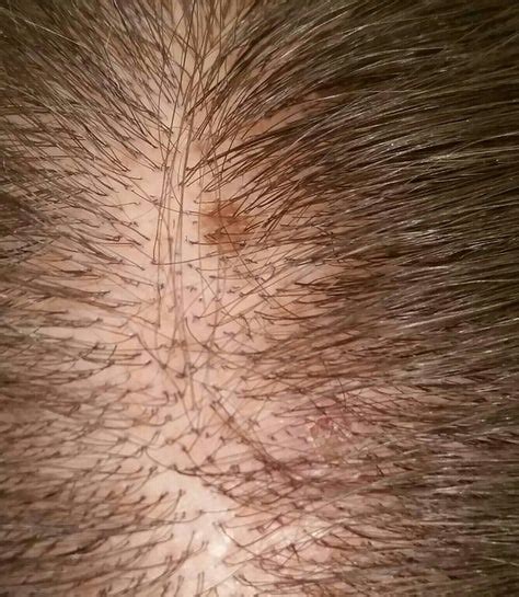 What Are The Brown Crusty Spots On My Scalp