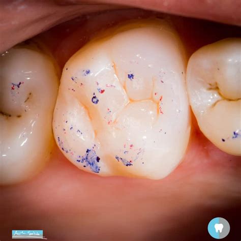 The Best Capping Material Myzerodonto