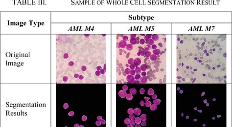 Table I From Classification Of Cell Types In Acute Myeloid Leukemia