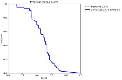 Deep Learning Approach For Arm Fracture Detection Based On An Improved Yolov8 Algorithm