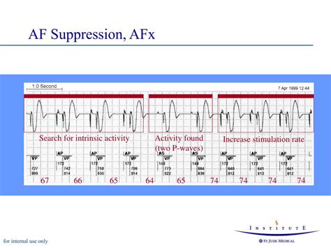 PPT AF Suppression PowerPoint Presentation Free Download ID