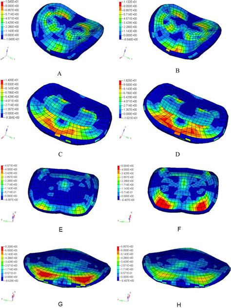 Comparison Of Intradiscal Pressure Distribution Of Superior A B And