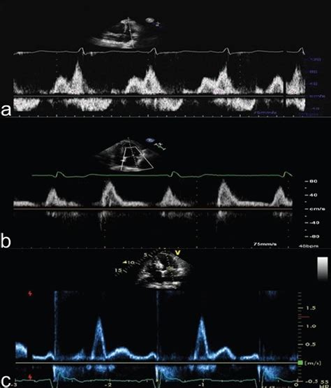 Pulsed Wave Doppler Interrogation Of The Mitral Valve At The Level Of Download Scientific
