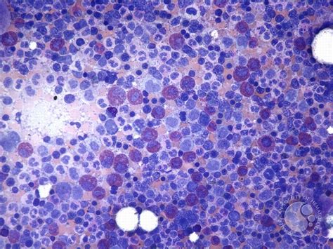 Eosinophilia Bone Marrow Aspirate 1