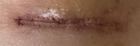 3 Month Progress After Keloid Removal Surgery R Keloids