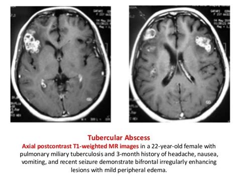 Clinical Radiology Cerebral Tuberculosis