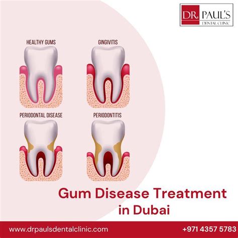 Gum Disease Treatment Dubai Artofit