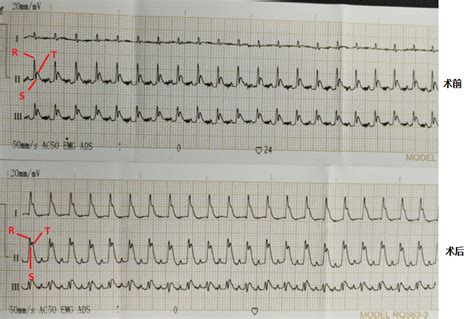 大鼠心肌梗死模型 Myocardial infarction 中洪博元商城 疾病动物模型 实验动物 动物实验物资