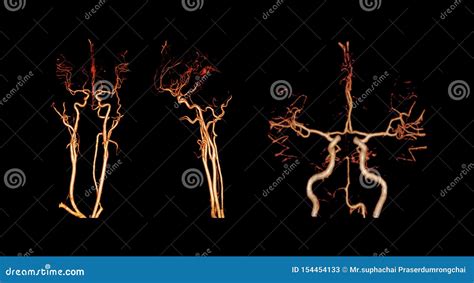 Cta Brain Os Ct Angiography Of The Brain 3d Rendering Image Stock Image Image Of Media