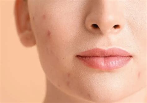 فواید آبرسان برای پوست خشک 8 مورد