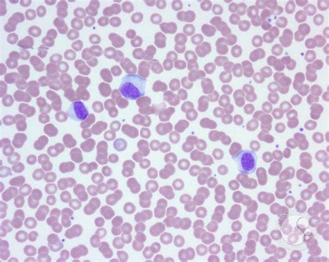 Infectious Mononucleosis 1