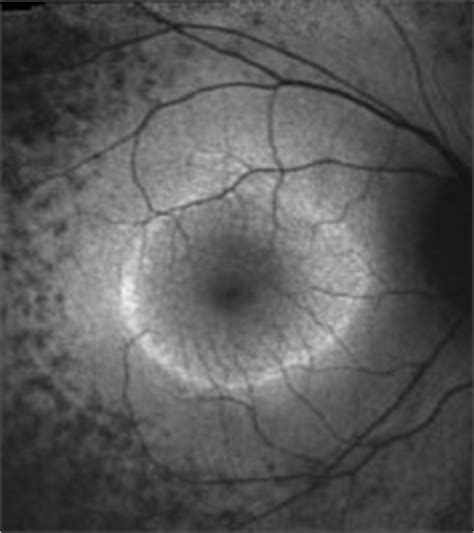 Faf Imaging For Retinal Diseases