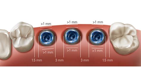 Biohorizons Guided Implant Surgery