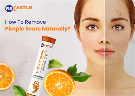 Naturally Remove Pimple Scars Simple Tips And Easy Remedies