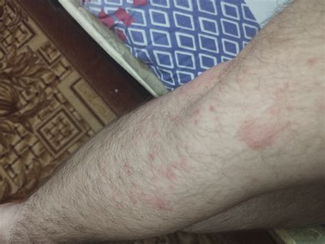 Красные высыпания на ногах руках животе и локтях С недавних пор недели Medaboutme