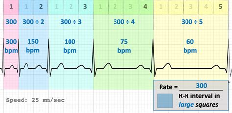 ECG Rate Interpretation LITFL Medical Blog ECG Library Basics