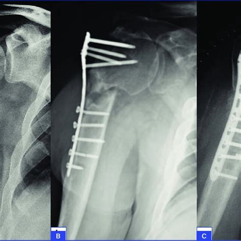 A B Female Of 67 Y O With A Proximal Humerus Fracture C Orif Download Scientific Diagram