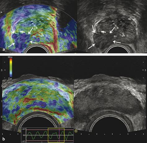 Elastography Of The Prostate Radiology Key