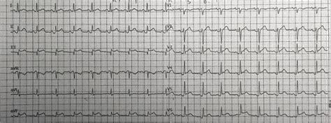 Supradenivelarea De Segment St