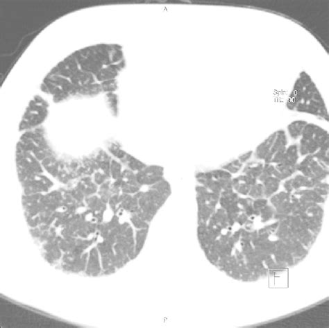 Case 7 Ct Scan Showing Lung Fields With Interstitial Thickening
