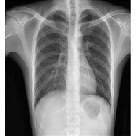 Pdf Ai Assisted Tuberculosis Detection And Classification From Chest