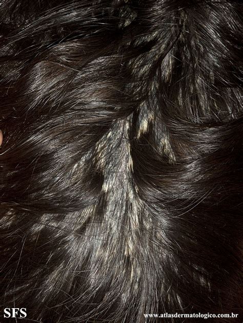 Pityriasis Amiantacea Nc Commons