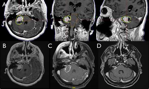 Stereotactic Radiosurgery For Vestibular Schwannoma — A Case Based Practice Guide From The